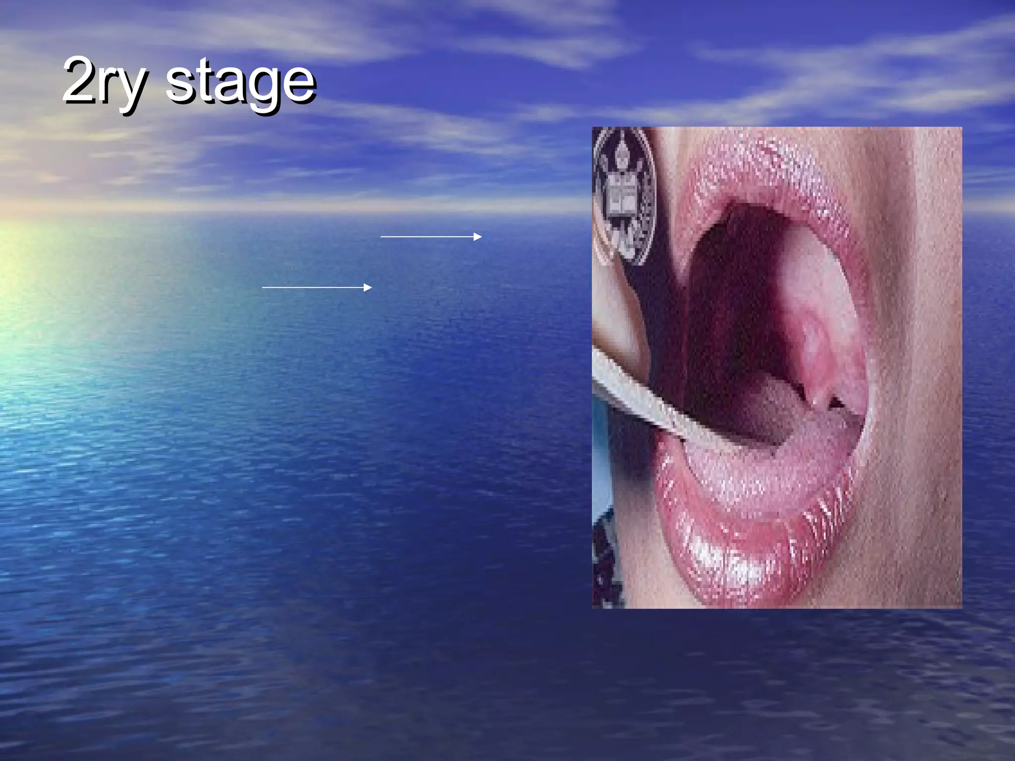 Oral ulcer revision 1 | PPT
