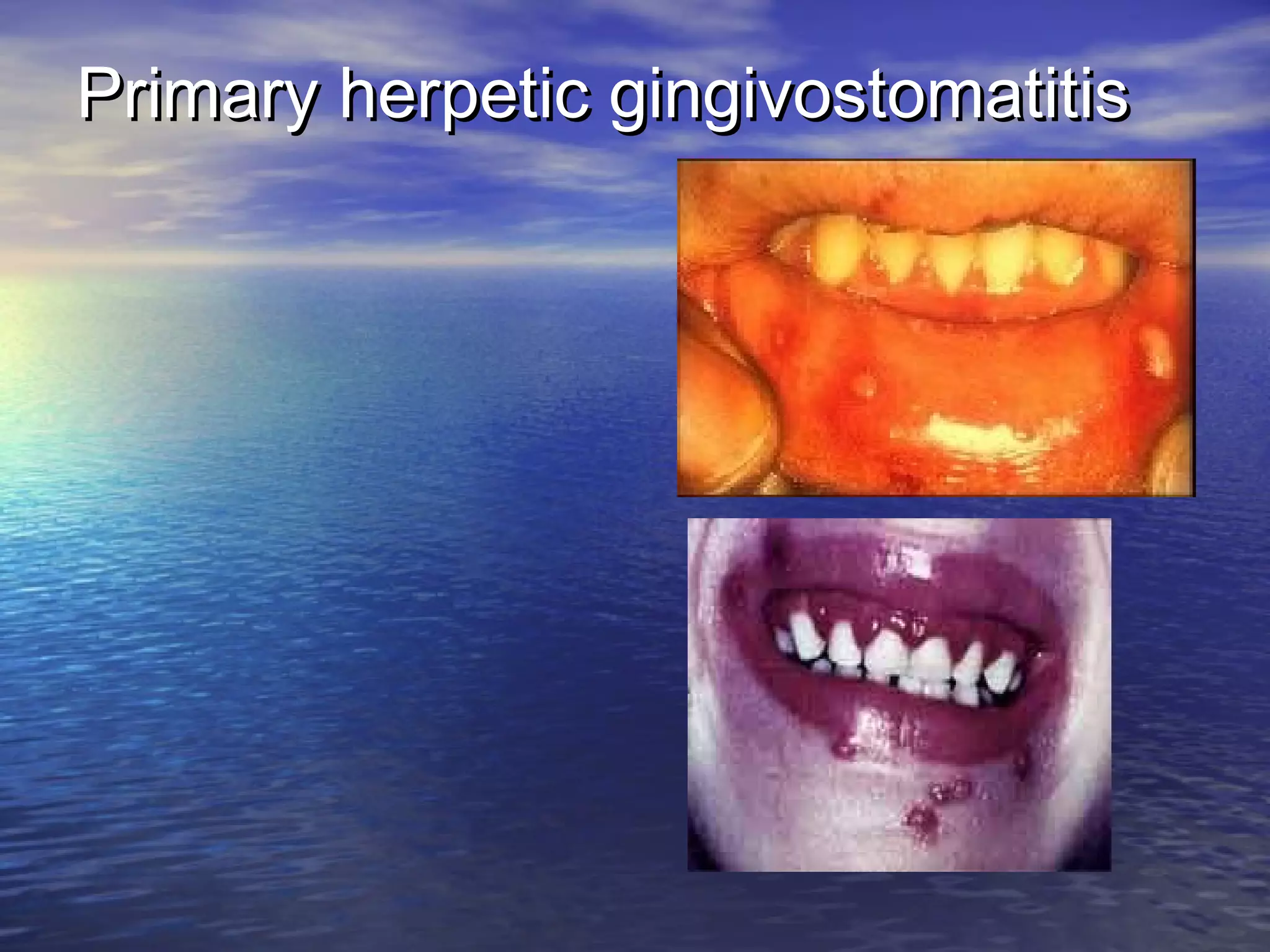 Oral ulcer revision 1 | PPT