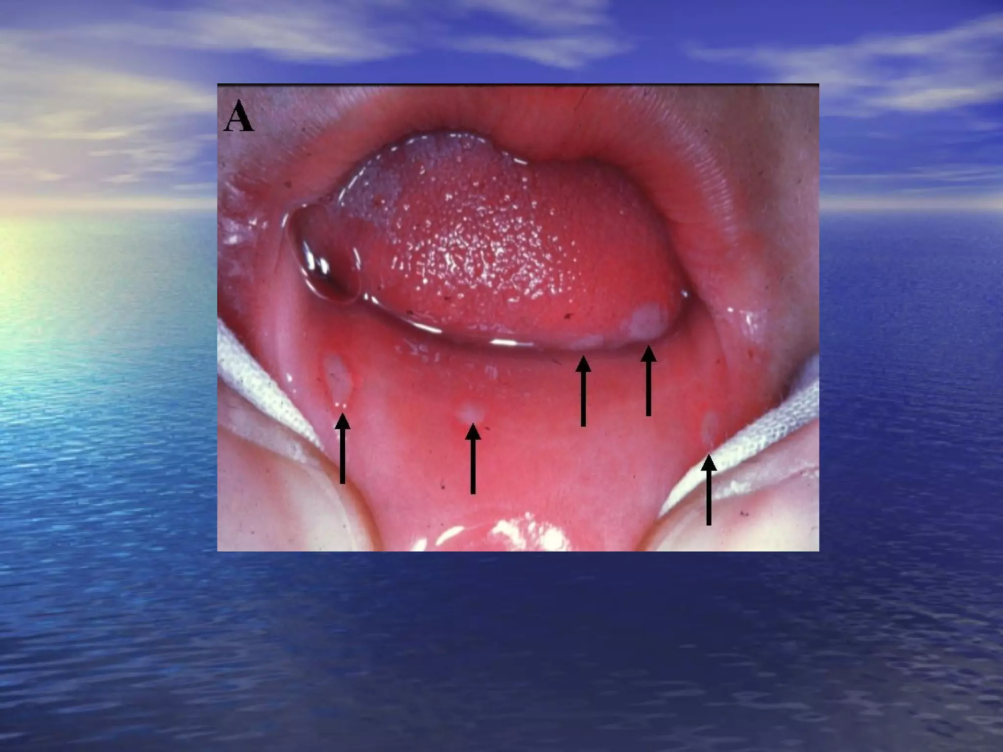 Oral ulcer revision 1 | PPT