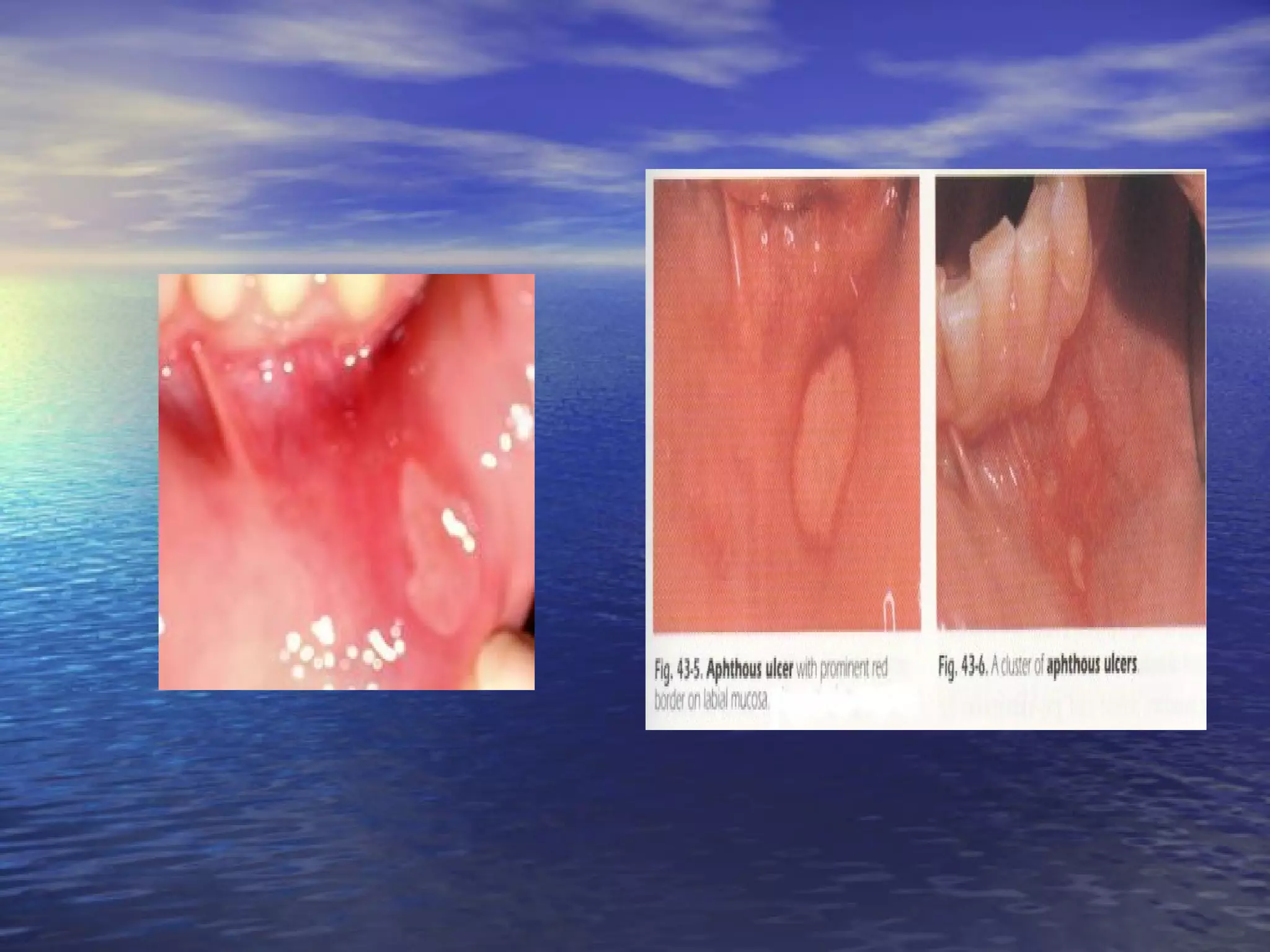 Oral ulcer revision 1 | PPT