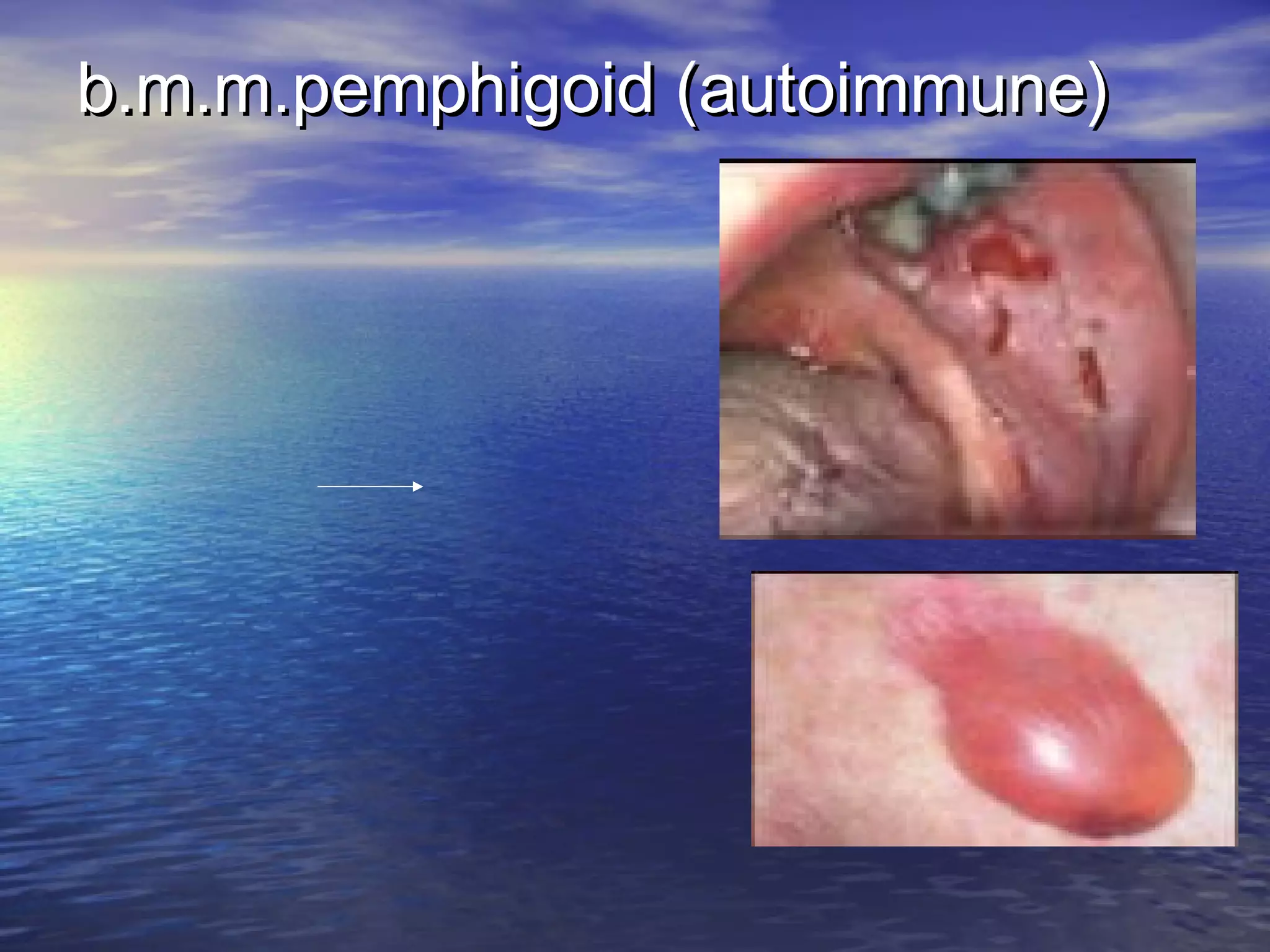 Oral Ulcer Revision 1 Ppt