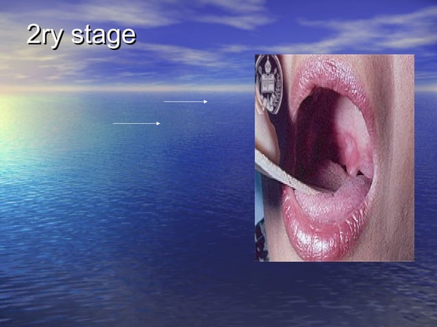 Oral ulcer revision 1 | PPT