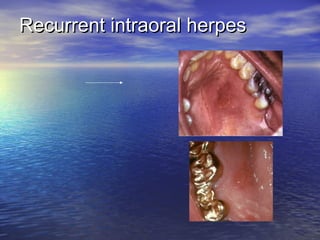 Oral ulcer revision 1 | PPT