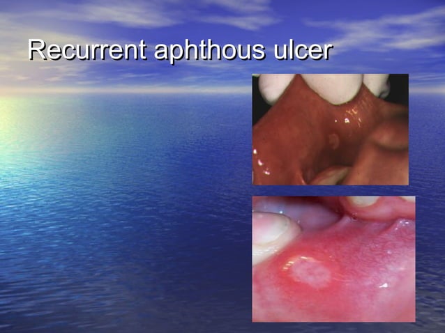 Oral ulcer revision 1 | PPT