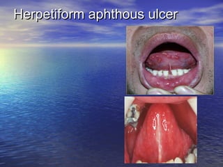 Oral ulcer revision 1 | PPT