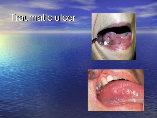 Oral ulcer revision 1