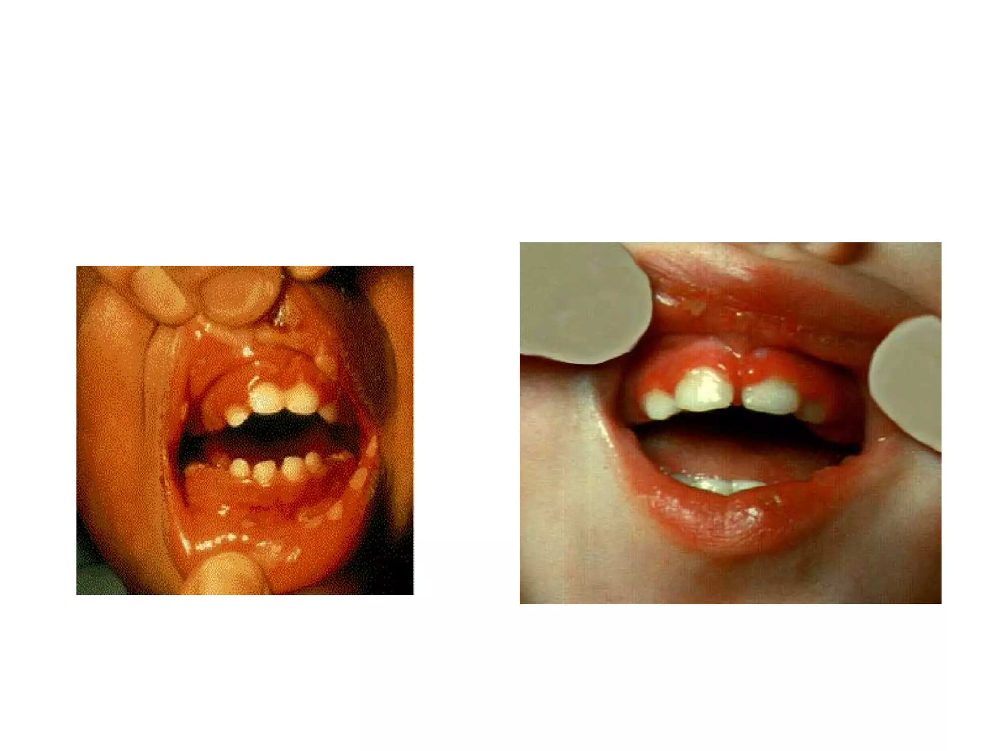 Oral ulcers | PPT