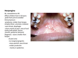 Oral ulcers | PPT