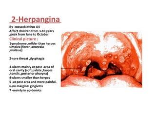 Oral ulcers | PPT