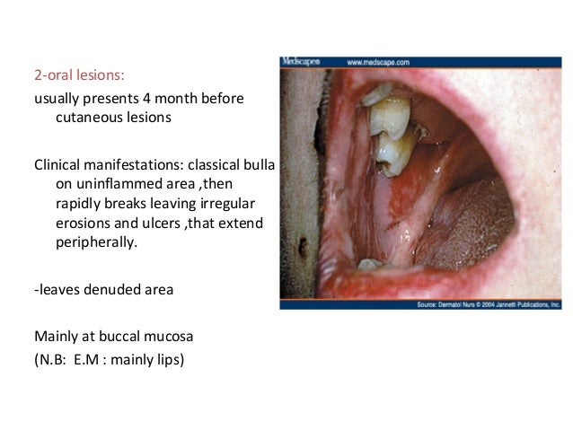 Oral ulcers