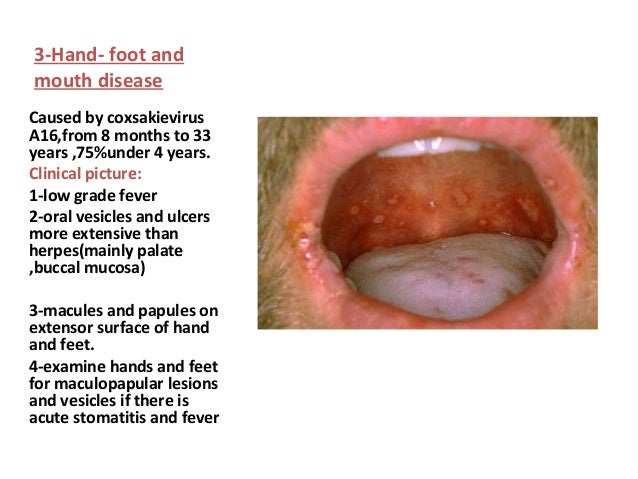 Oral Ulcers