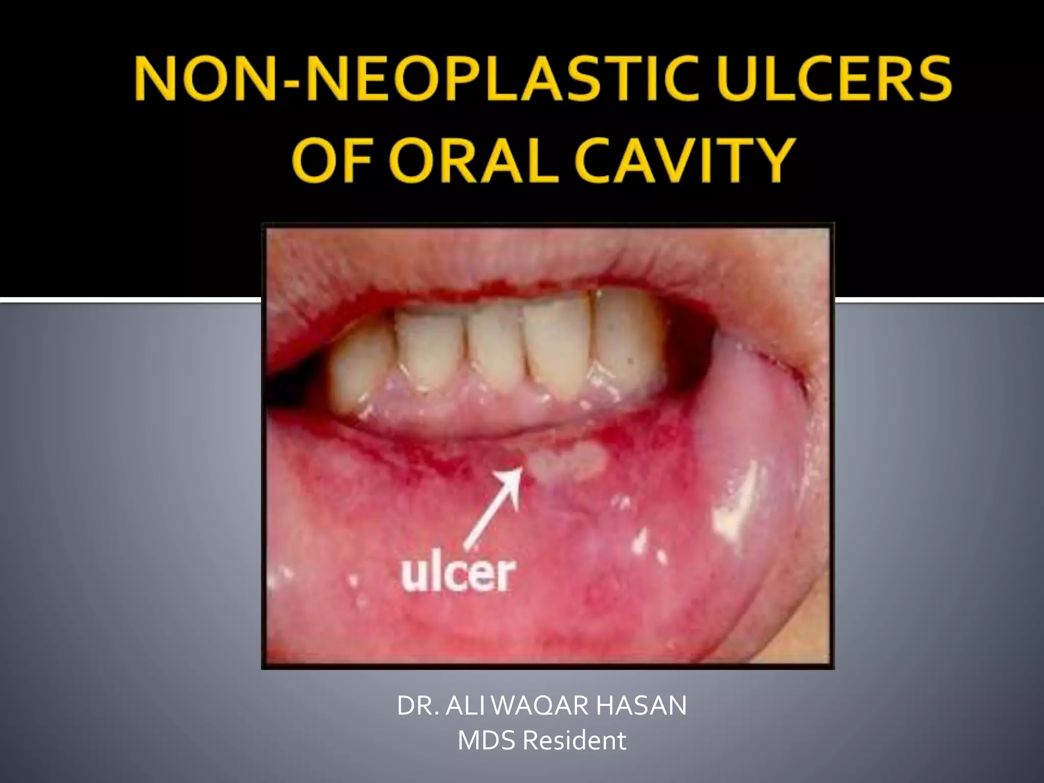Oral ulcers | PPTX