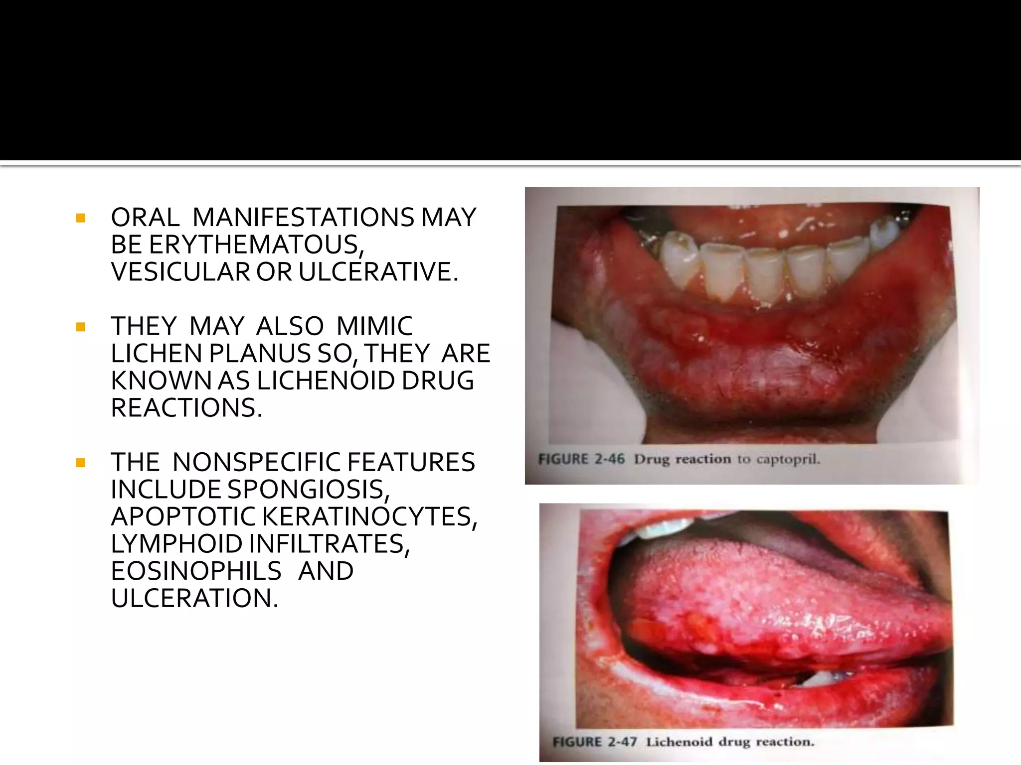 Oral ulcers | PPTX