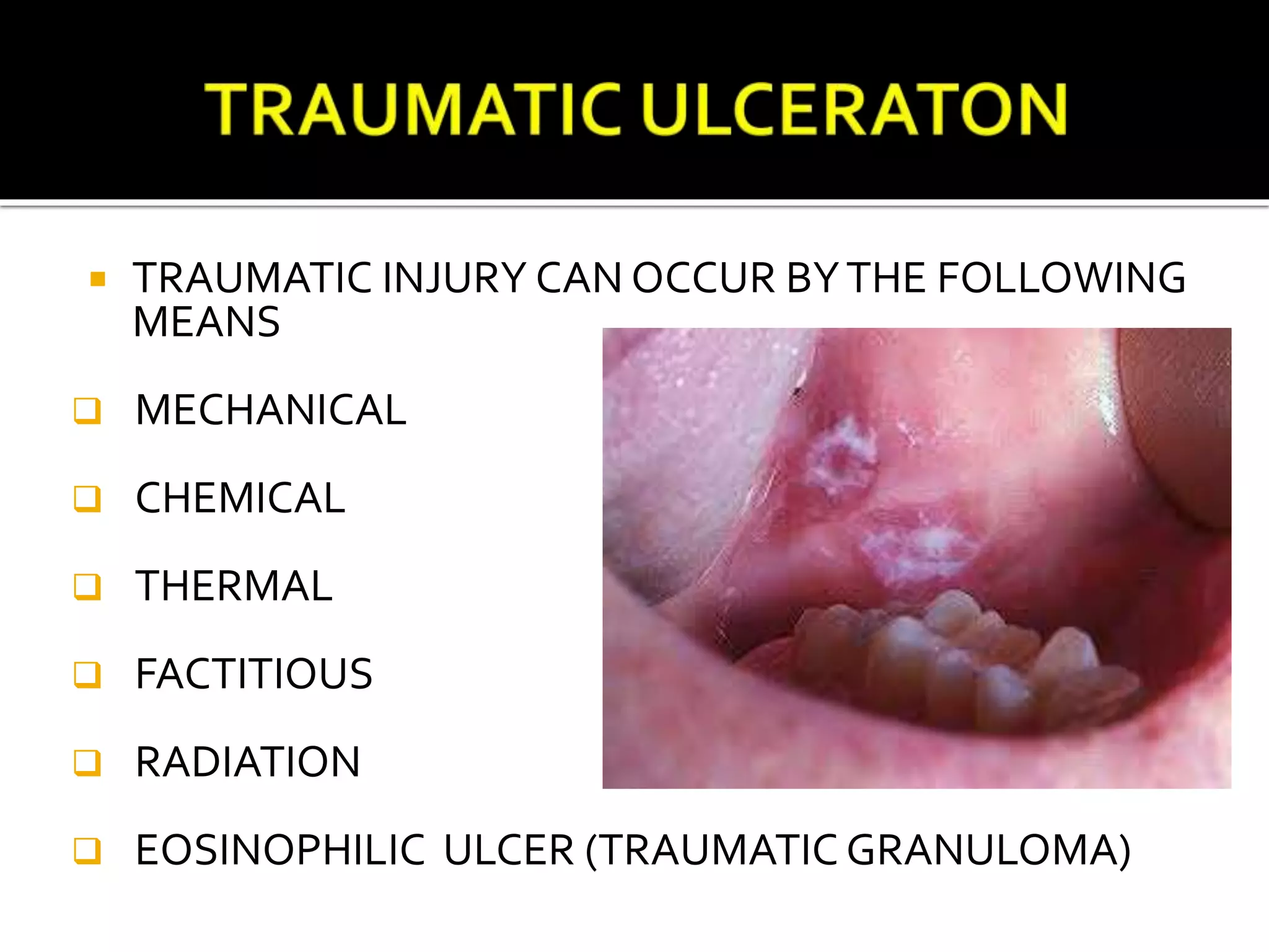 Oral ulcers | PPTX