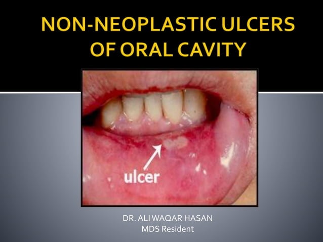 Oral ulcers | PPTX