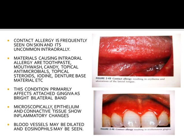 Oral ulcers | PPTX