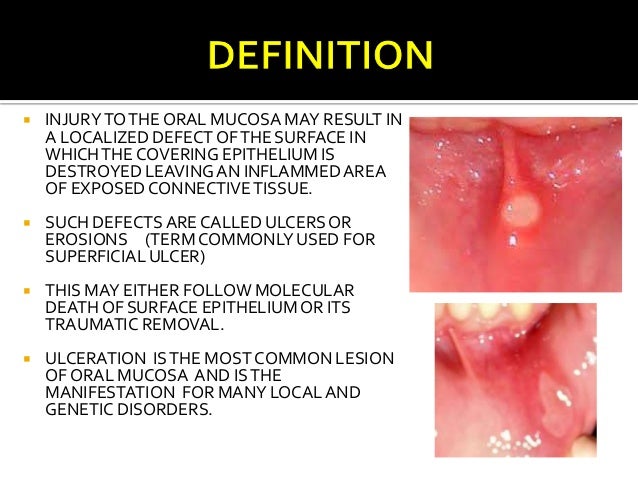 Oral ulcers