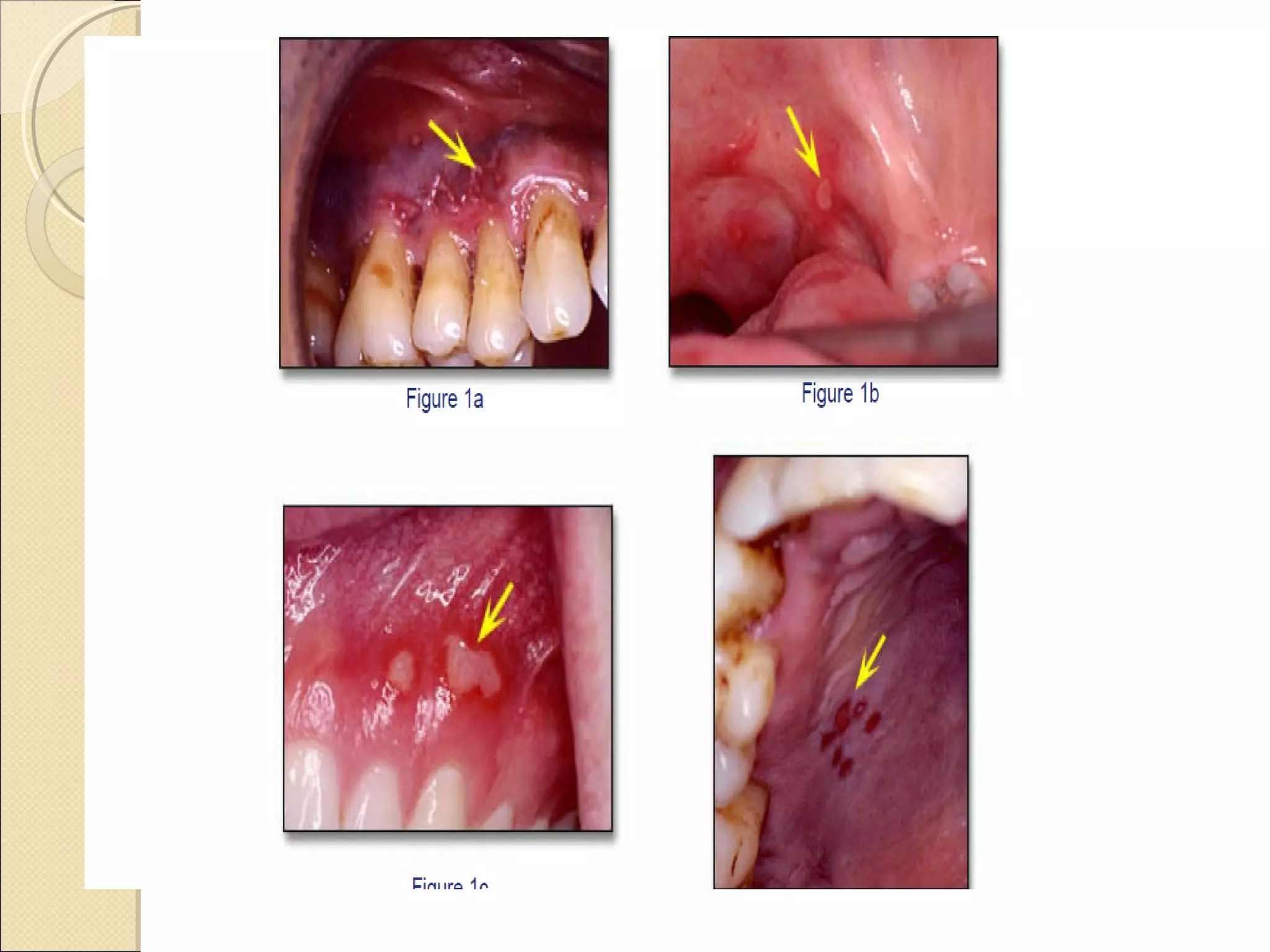 Oral ulcers | PPT