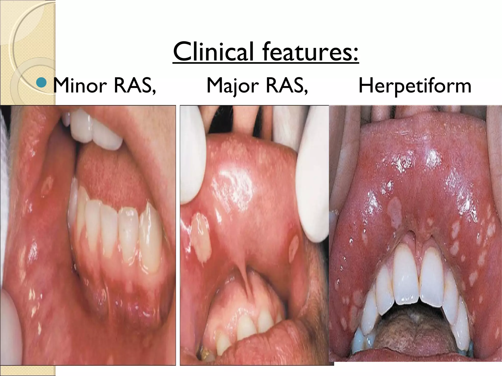 Oral ulcers | PPT