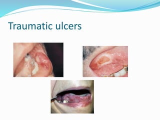 Oral mucosa ulcers.pdf. lecture oral medicine | PDF