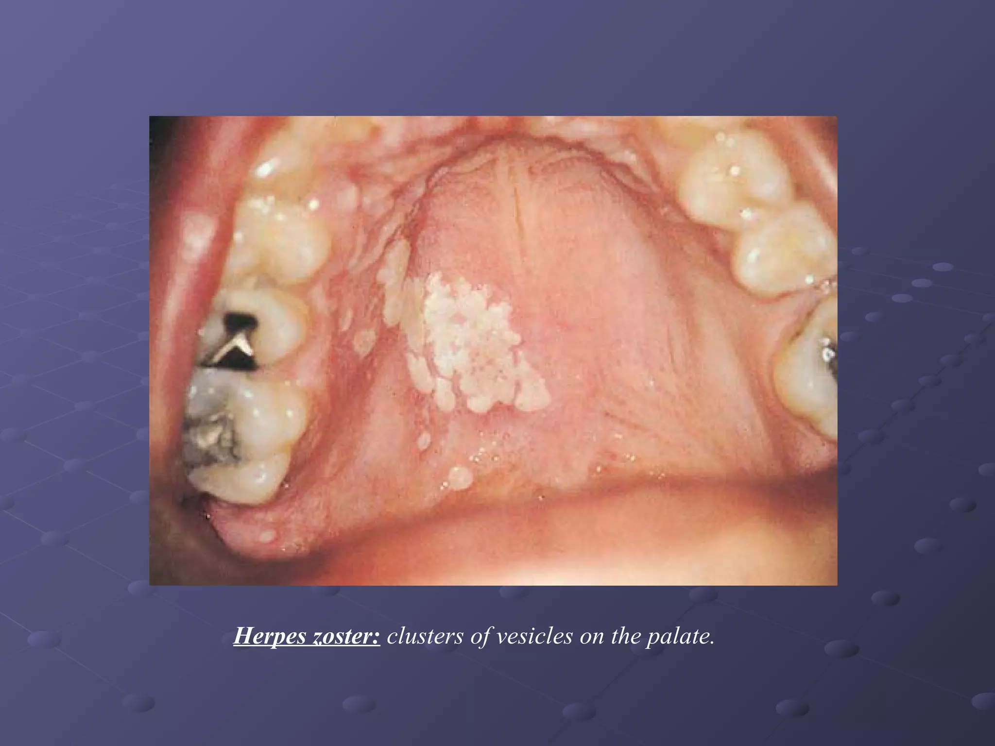 Oral ulcers(collection) | PPT