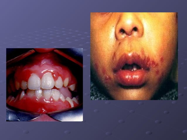 Oral ulcers(collection) | PPT | Infectious Diseases | Diseases and ...