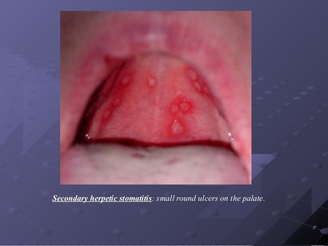 Oral Ulcerscollection
