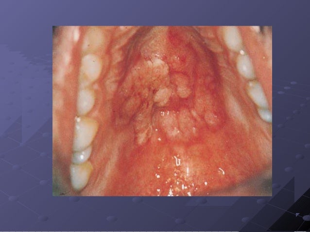 Oral ulcers(collection)