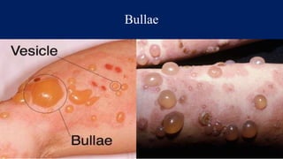 Oral ulcers introduction | PPTX