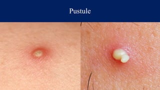 Oral ulcers introduction | PPTX