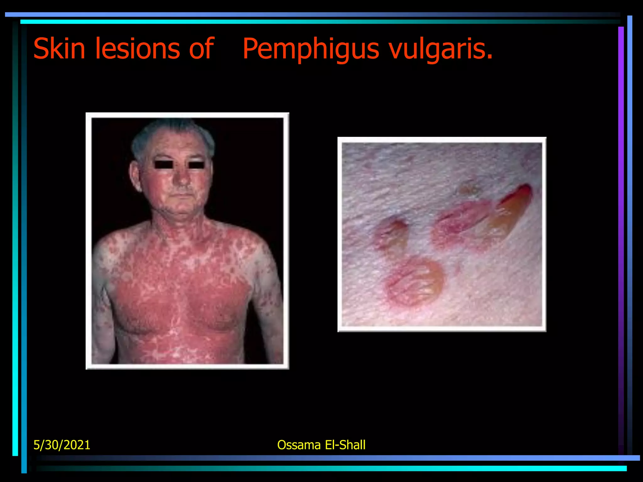 Oral ulcers part 2 | PPT