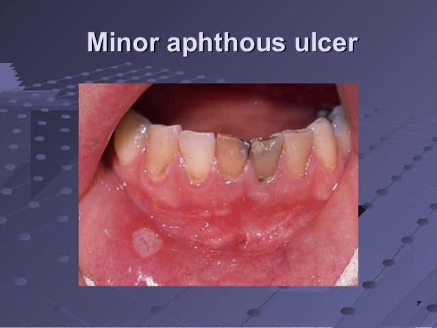 Oral ulcersppt