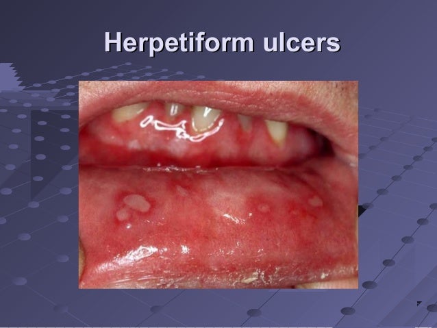 Oral ulcersppt