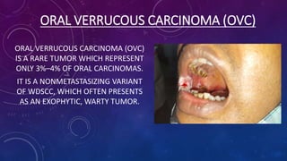 Oral verrucous carcinoma (OVC).pptx
