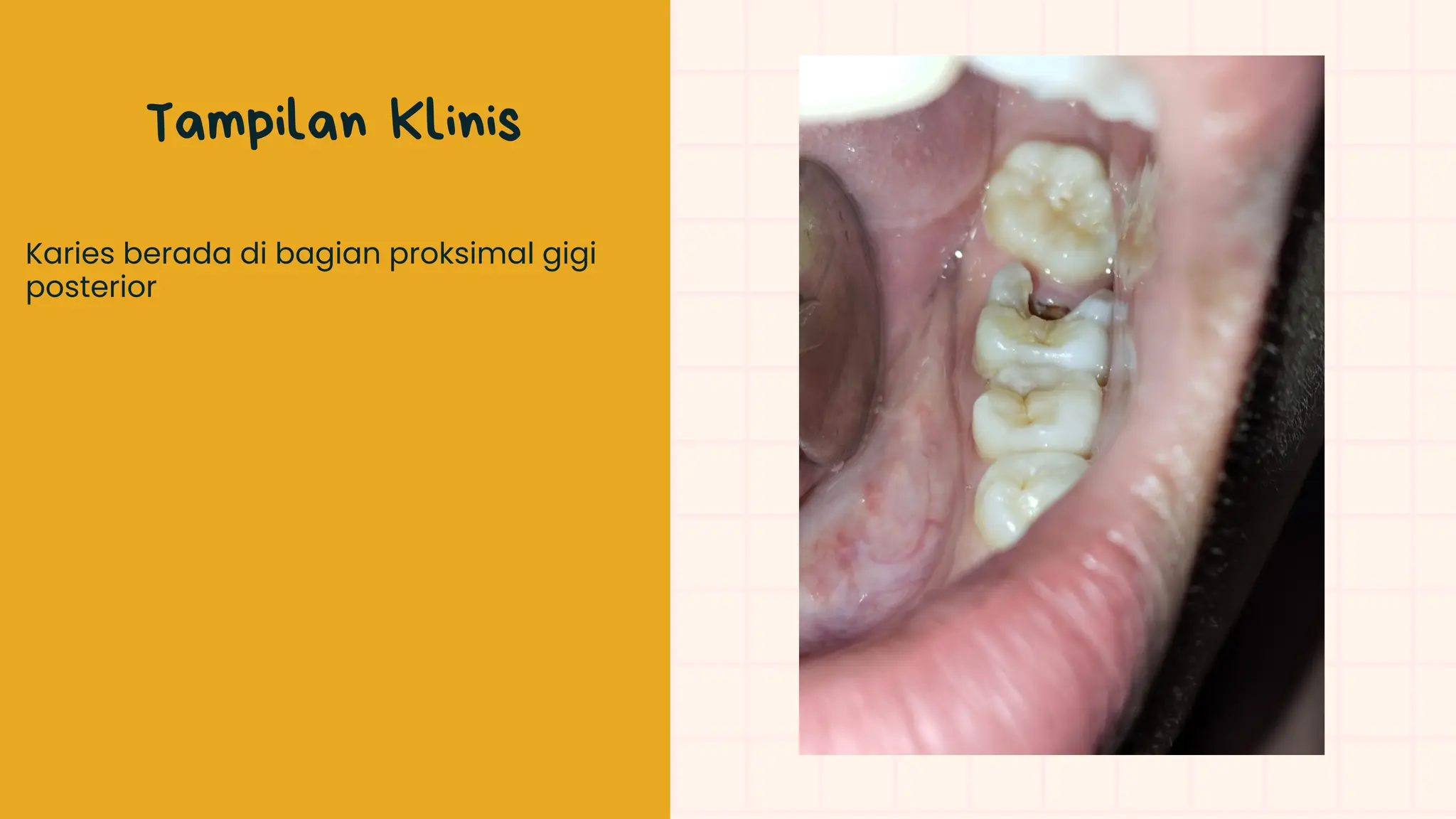Laporan kasus restorasi kelas 2 komposit.pdf