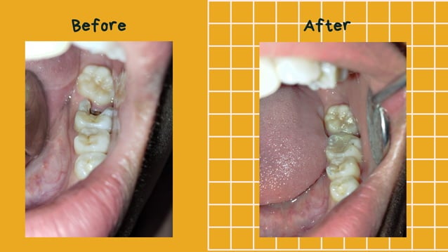 Laporan kasus restorasi kelas 2 komposit.pdf