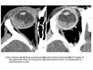 Diagnostic Imaging of Orbital Lesions | PPT