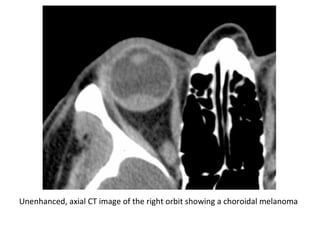 Diagnostic Imaging of Orbital Lesions | PPT