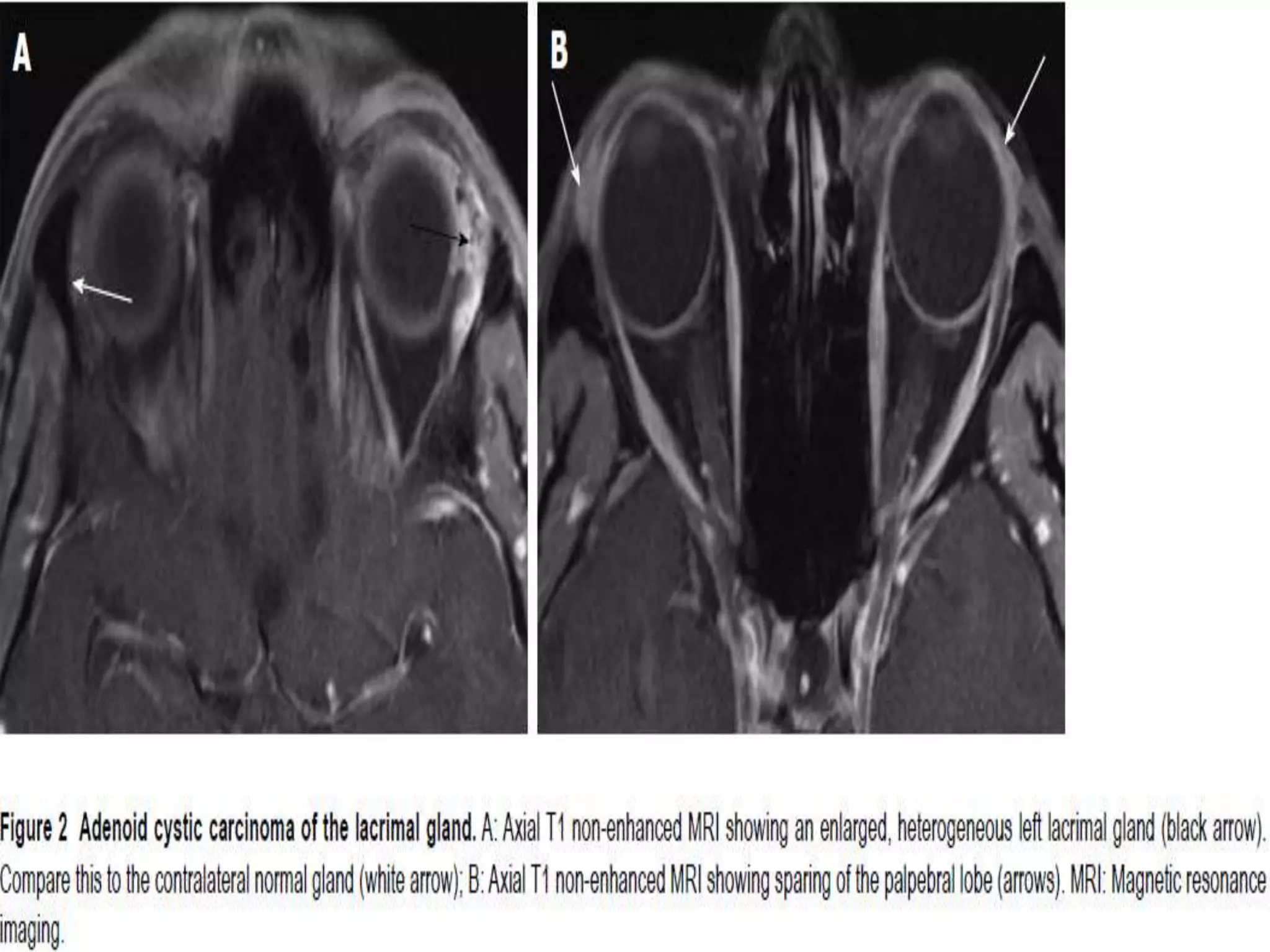 idiopathic orbital inflammatory syndrome | PPTX