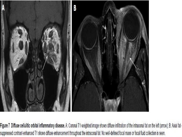 idiopathic orbital inflammatory syndrome