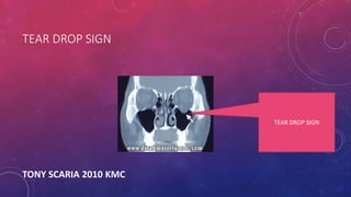 Orbit OPHTHALMOLOGY REVISION NOTES | PPT
