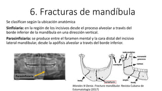 Fracturas de cráneo | PPTX