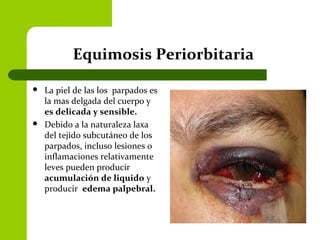 Equimosis Periorbitaria