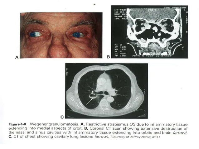 Orbital Apex Syndrome | PPTX | Ear, Nose and Throat Conditions ...