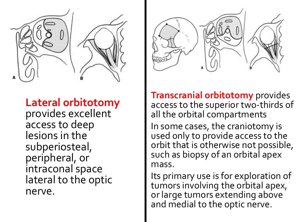 Orbital Apex Syndrome