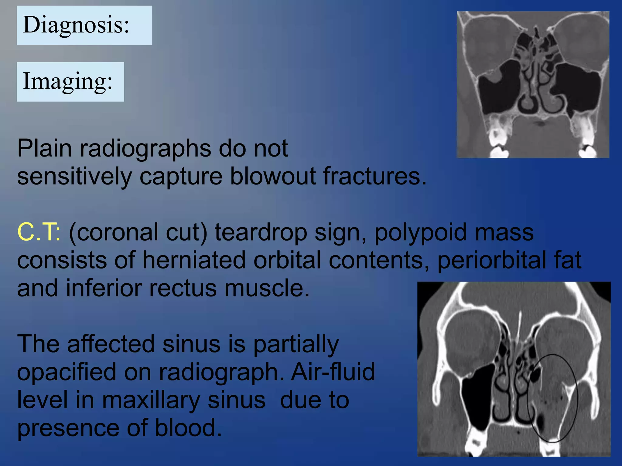 Orbital Blowout Fracture Ppt