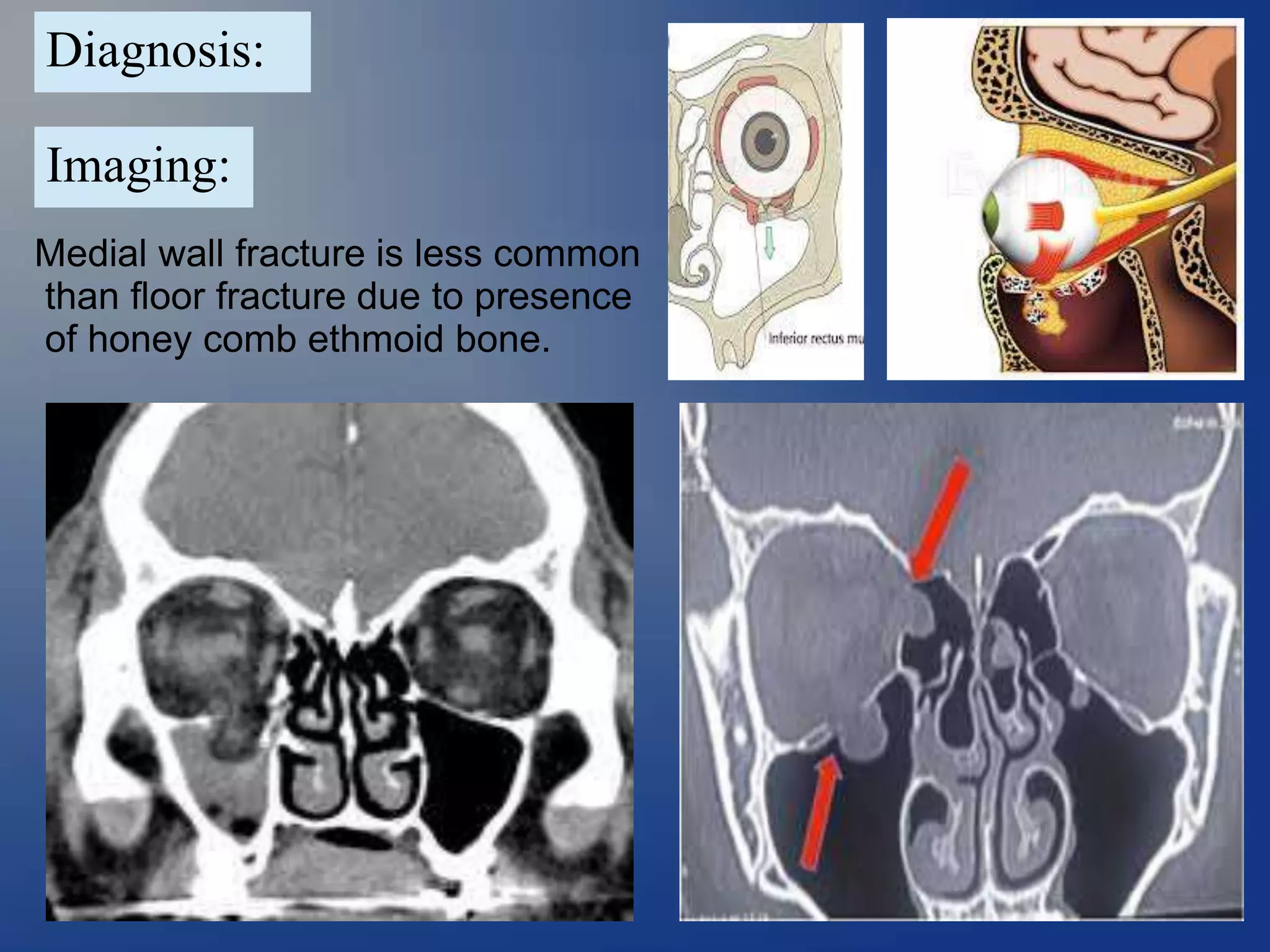 Orbital Blowout Fracture Ppt