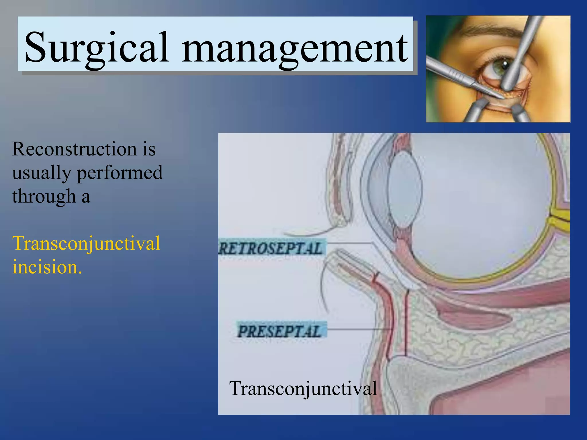 Orbital Blowout Fracture Ppt