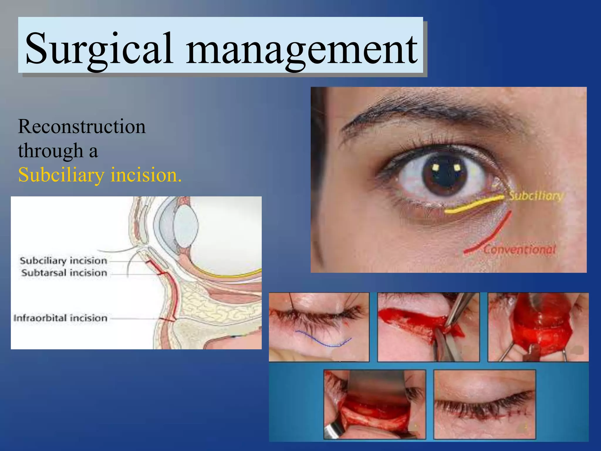 Orbital Blowout Fracture Ppt