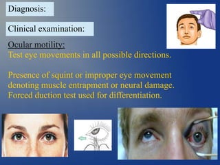 Orbital blowout fracture | PPT